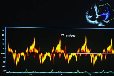 Tissue Doppler Imaging Of The Lateral Mitral Annulus Showed A Prominent Download Scientific