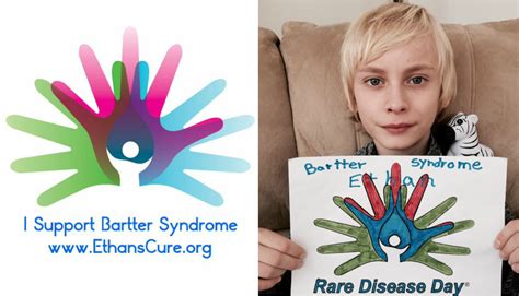 Bartter Syndrome Foundation Associazione Bartter Gitelman