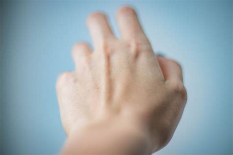Artrita Psoriazica Cauze Si Tratament Bodygeek