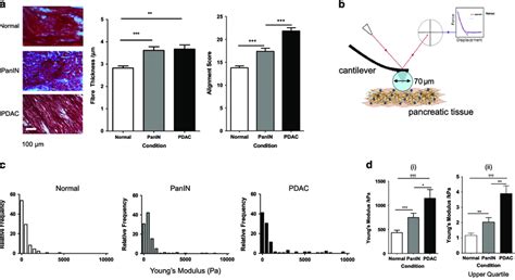 In Vivo Characterisation Of Extracellular Changes During PDAC