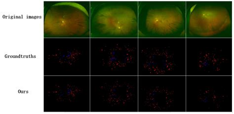 Lightweight Frequency Recalibration Network For Diabetic Retinopathy
