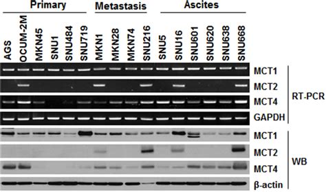 Expression Levels Of Mcts Mct1 Mct2 And Mct4 In Gastric Cancer Cell
