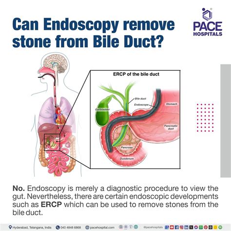 Choledocholithiasis Refers Pace Hospitals Hitech City