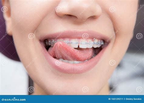 Smiling Happy Woman Mouth With Tongue And Braces Stock Image Image Of Clinic Care