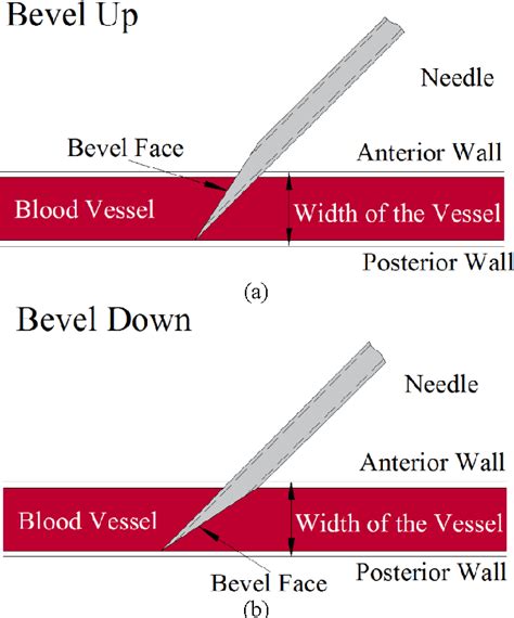 Figure 4 From Investigation Of Needle Bevel Face Up And Down