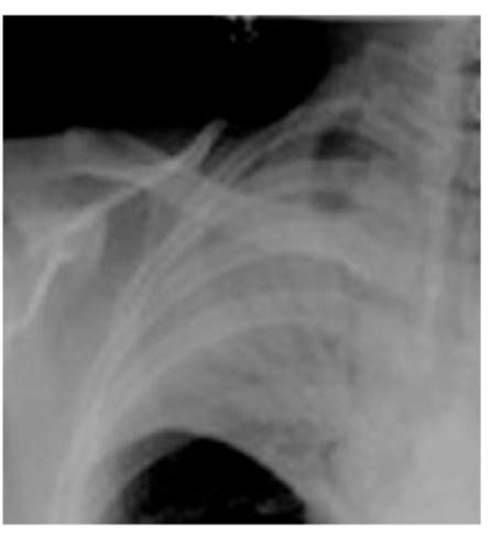 Week 2 Lecture 1 Chest Flashcards Quizlet