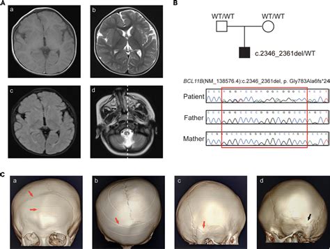 Frontiers Case Report A Novel Truncating Variant Of Bcl11b Associated With Rare Feature Of