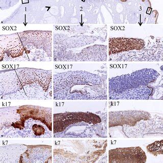 SOX Expression Patterns In Normal Cervical Epithelia AD Mutually