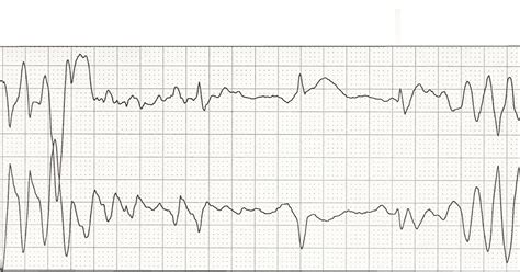 Float Nurse Ekg Rhythm Strips 12 Ventricular Rhythms