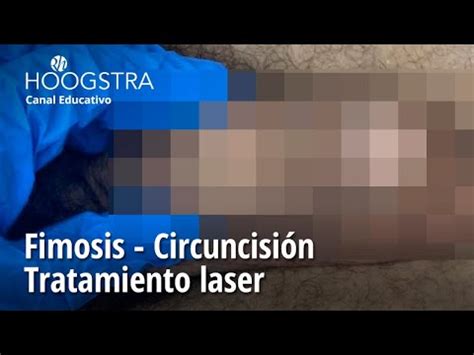 Fimosis Circuncisión Tratamiento laser 23084 YouTube