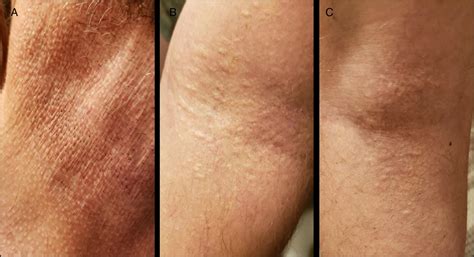 Pseudoxanthoma Elasticum Acg Case Reports Journal