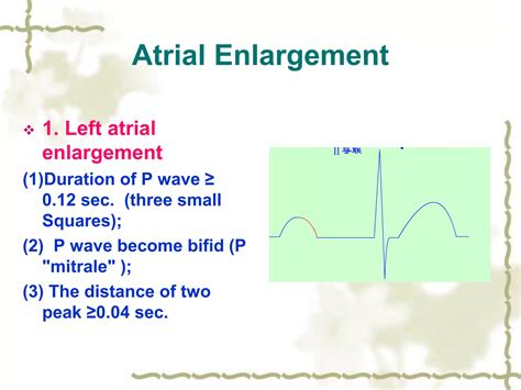 Atrial Enlargement And Ventricularppt