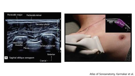 Pecs Block Serratus Plane Block With Literature Review When And How Pptx