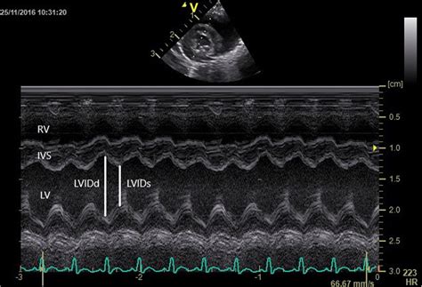 Time Motion Echocardiographic Right Parasternal Short Axis View At The
