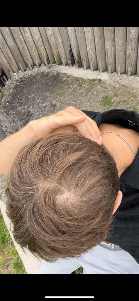 Finasteride 5 Month Minox 6 Month Progress Rtressless