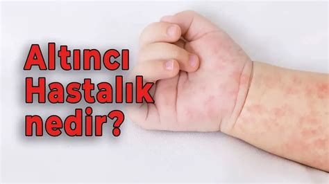 Altıncı Hastalık nedir Kütahya Ekspres