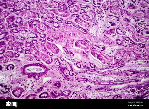 Glomerulonephritis Light Micrograph Of Tissue From A Kidney In A Case