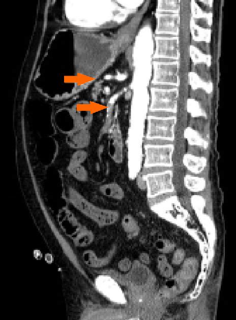 Figure 1 From Colonoscopy Related Colonic Ischemia Semantic Scholar