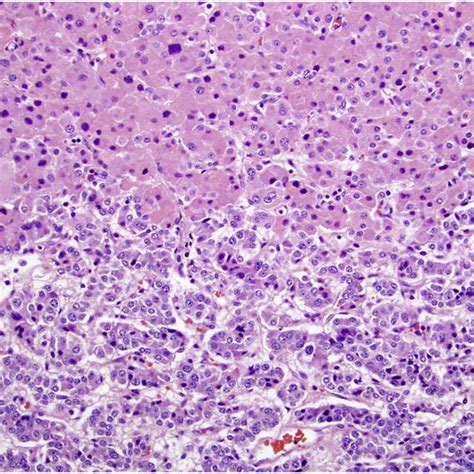 Interface Between Oncocytic Component Top And Non Oncocytic Cells In Download Scientific