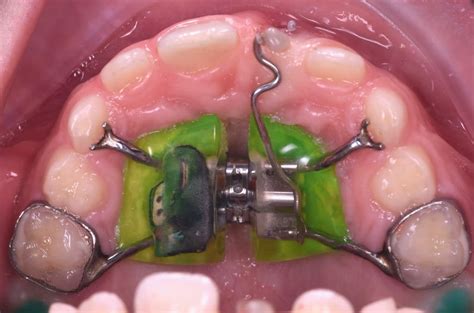 Marco Rosa Apparatus Haas Apparatus What Is It Prices What Is Important To Know