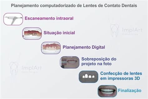 Contact Lenses For Teeth Implart Aesthetic Dental Contact Lenses