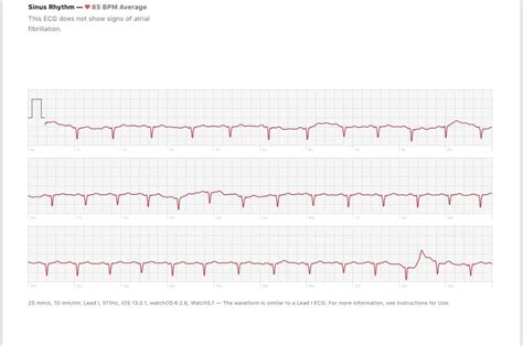 Inverted Qrs Shown On Apple Watch Ecg Im A Healthy 22 Year Old Trying