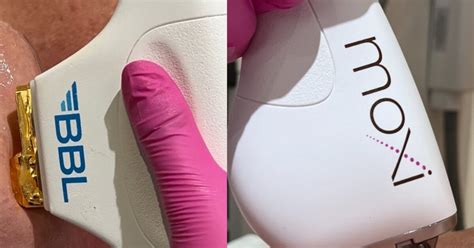 A Patient Journey With Broad Band Light Bbl Moxi… Woodford Medical