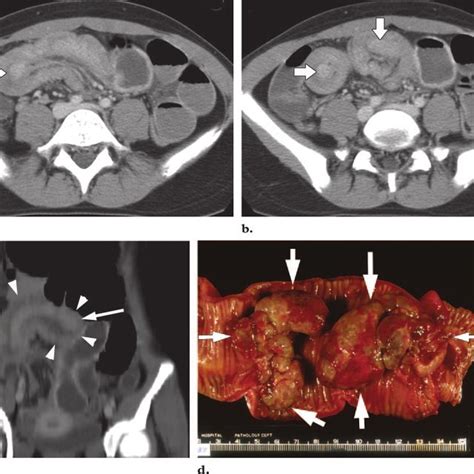 Transient Type Small Bowel Intussusception In A 54 Year Old Woman