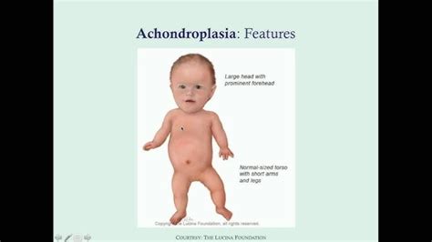 Medical Pictures Info Achondroplasia Achondroplasia Syndrome