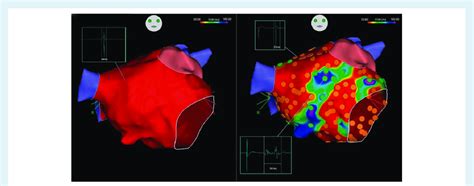 Electrogram Duration Maps The Left Panel Shows The Colour Coded Egm Download Scientific