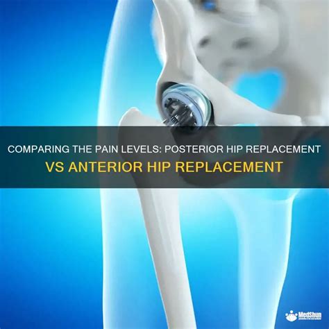 Comparing The Pain Levels Posterior Hip Replacement Vs Anterior Hip