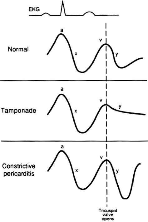 Abnormal Cvp Waveform