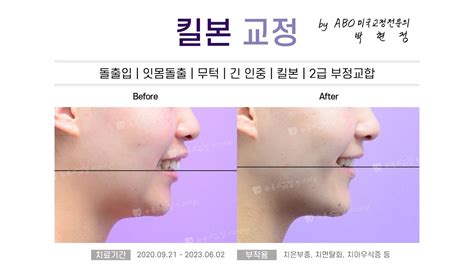 킬본교정전후 킬본교정돌출입잇몸돌출무턱긴인중킬본2급부정교합 Banda 대구창원통영경주 돌출입교정 뉴욕