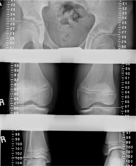 Xray Scanogram Youtube