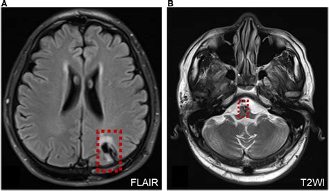 Frontiers The Spectrum Of Vestibular Disorders Presenting With Acute Continuous Vertigo