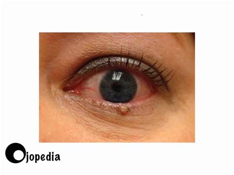 Fotos De Verrugas En Los Párpados En Ojopedia