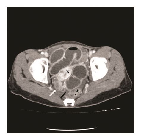 Axial Ct Image Shows Distended Proximal Bowel Loop And Collapsed Distal Download Scientific