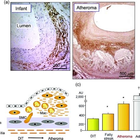 Localization And Activity Of Tissue Factor In Human Atherosclerotic