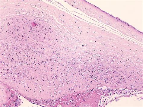 Chronic Inflammatory Conditions Of The Placenta Diagnostic Histopathology