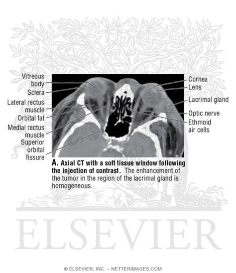 Axial Ct With A Soft Tissue Window Following The Injection Of Contrast