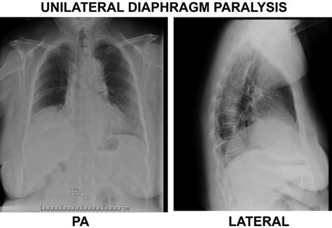 Disorders Of The Diaphragm Clinics In Chest Medicine