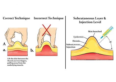 Subcutaneous Injection Technique Fat Dissolving Botox And Filler Injector Anatomy