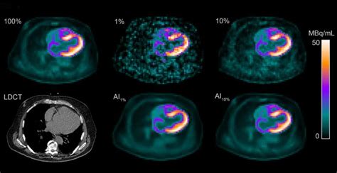 Nuclear Medicine Scan Heart