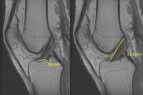 Measurement Of The Tibial Insertion Site A And Length B Of The