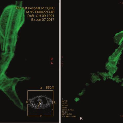 Three Dimensional Computed Tomography Reconstruction Of The Airway On Download Scientific