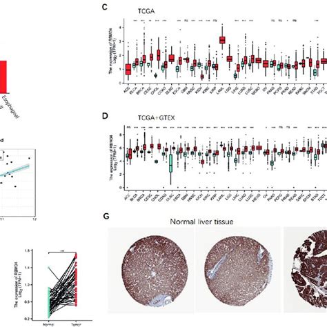 RBM34 Is Overexpressed In HCC A CBioPortal Examination Of TCGA