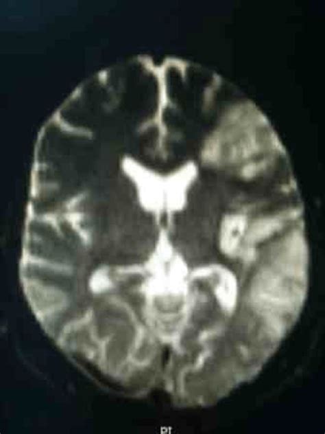 Diffusion Weighted Imaging Demonstrating Restriction Of Diffusion Download Scientific Diagram