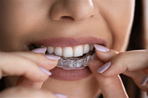 Navigating The Transformative World Of Clear Aligners