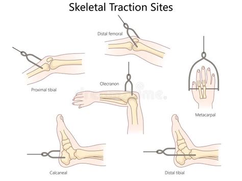 Skeletal Traction Sites Diagram Medical Science Stock Illustration