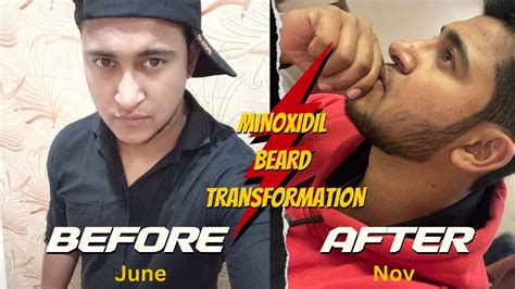 Six Months Beard Transformation Minoxidil Beard Growth Youtube